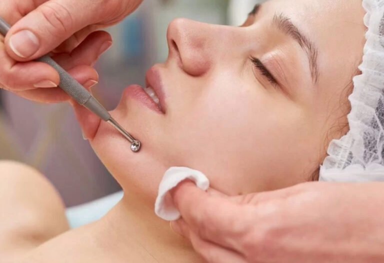 Pimples Extractions – Skinovita