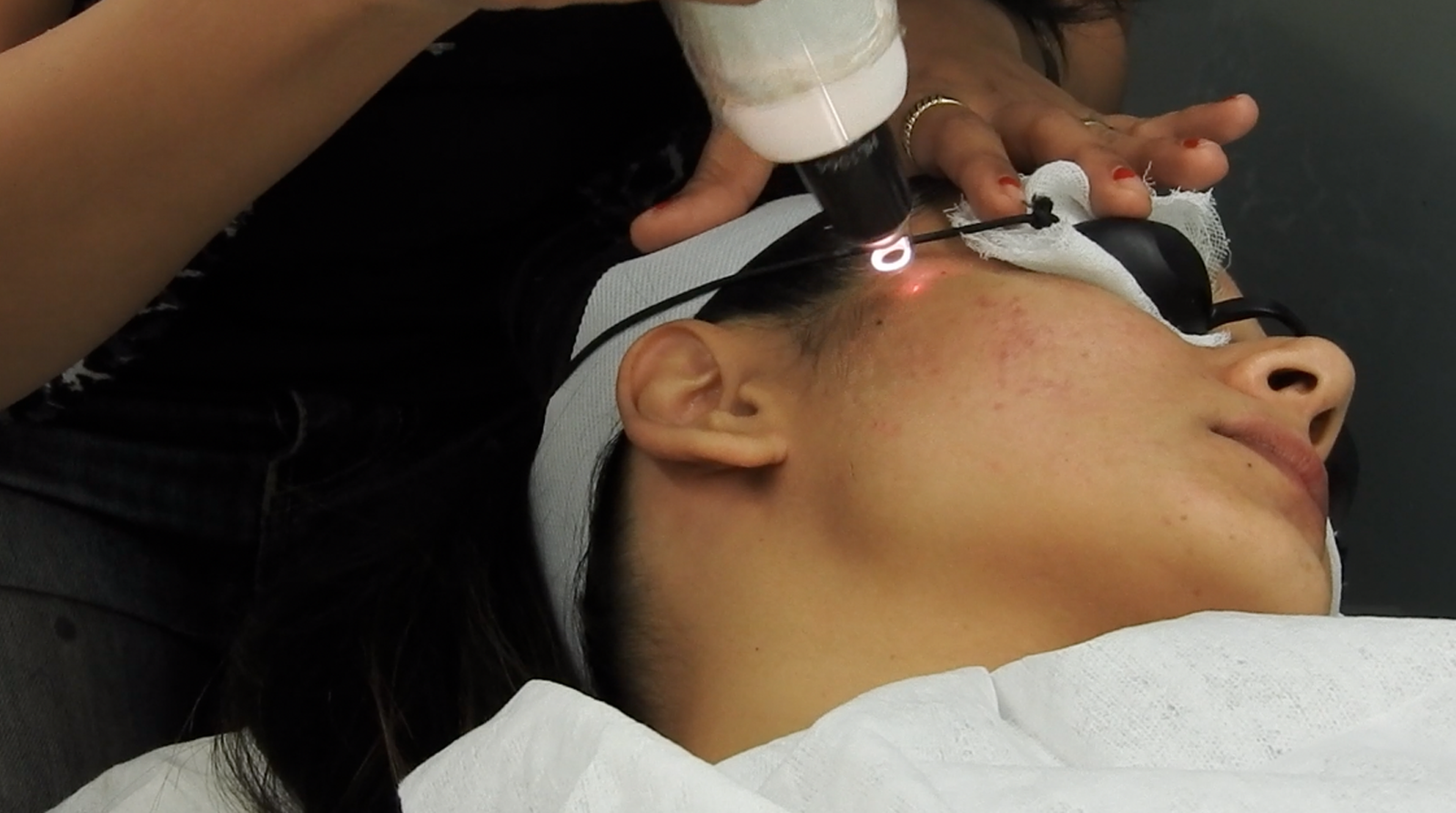 Q-switch Laser – Skinovita